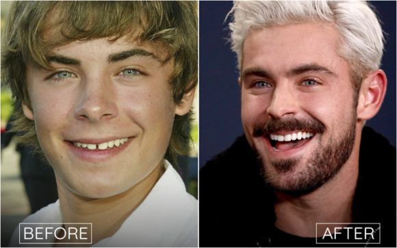 Celebrities Cosmetic Dentistry | Teeth Before and After