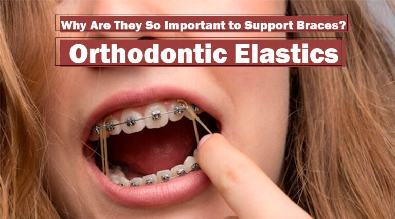 How Do Orthodontic Elastics Provide Support For My Braces?
