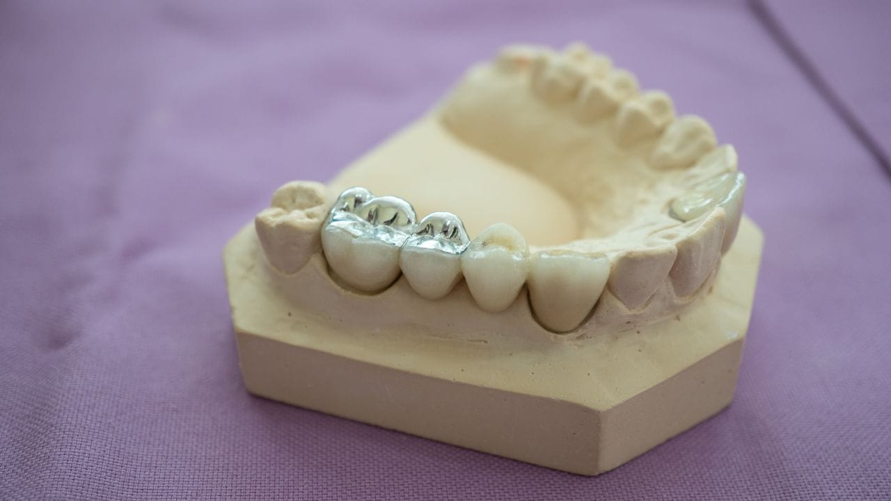 Amalgam Fillings: 3 Benefits to Restore Your Teeth Now