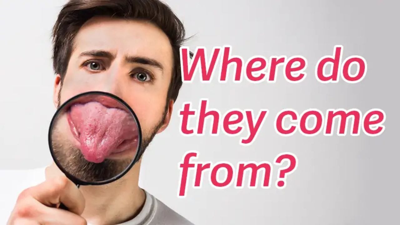 Bumps On The Tongue Transient Lingual Papillitis Facty Health