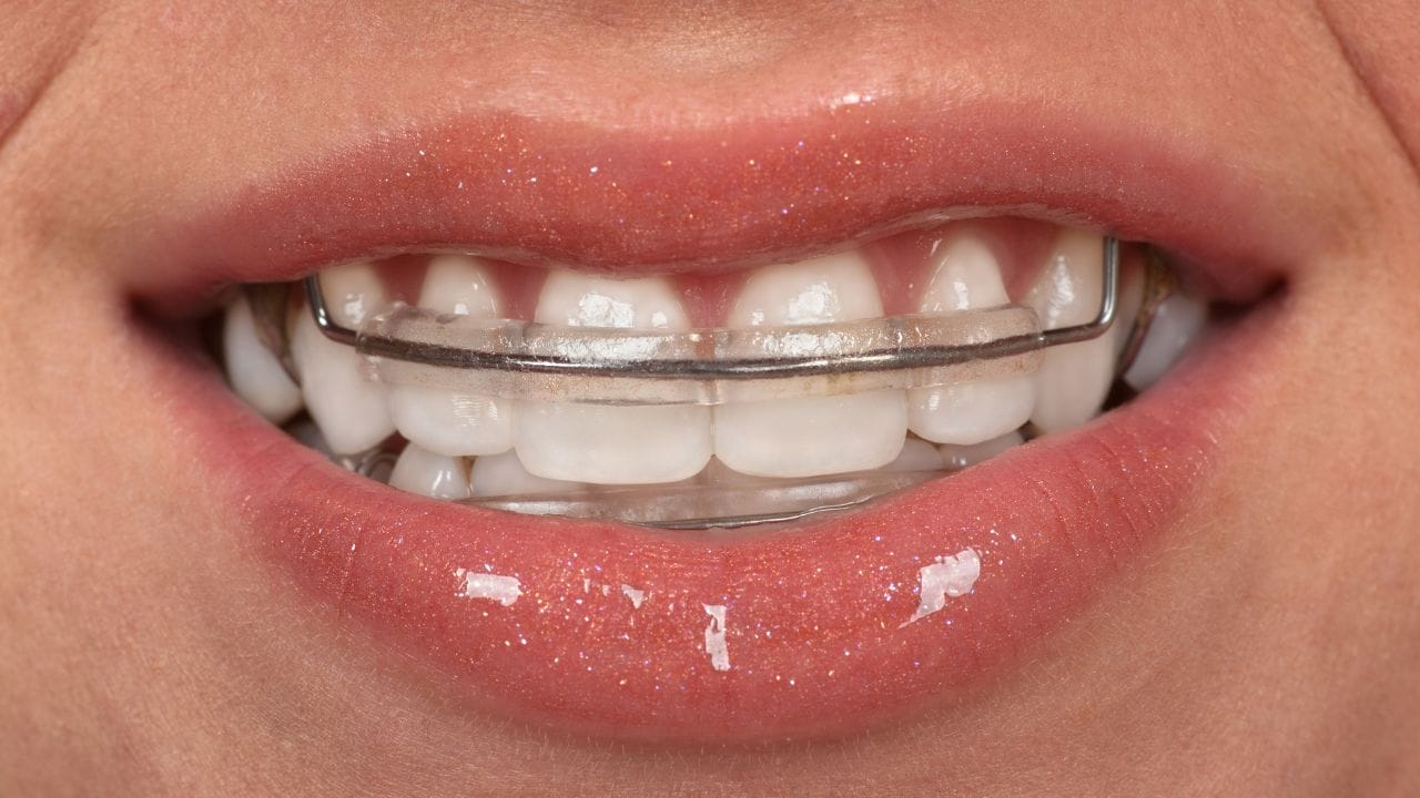 Permanent Retainer: 3 Advantages and Disadvantages